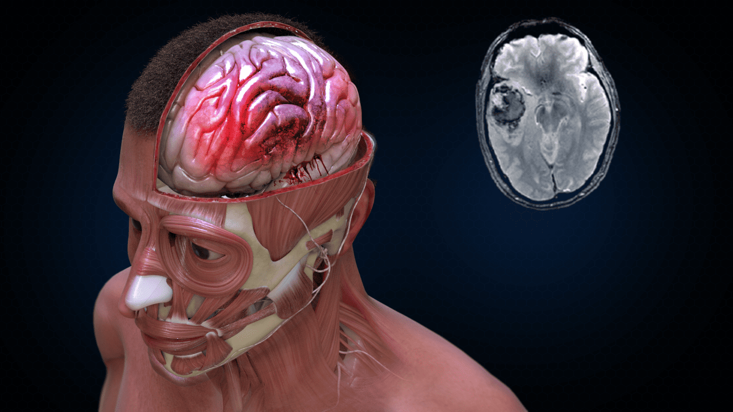 Illustrating Organic Brain Syndrome With Law Graphics | Fox-AE