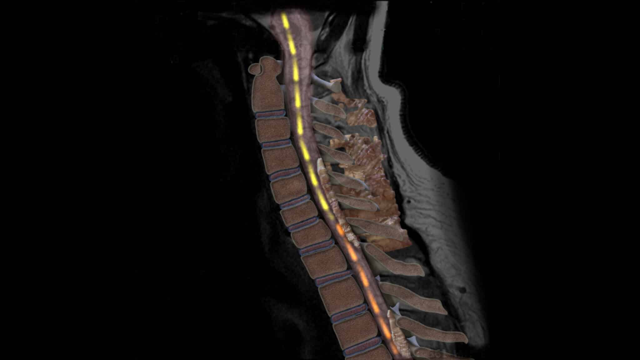 Spinal Compression | Fox Animated Engineering