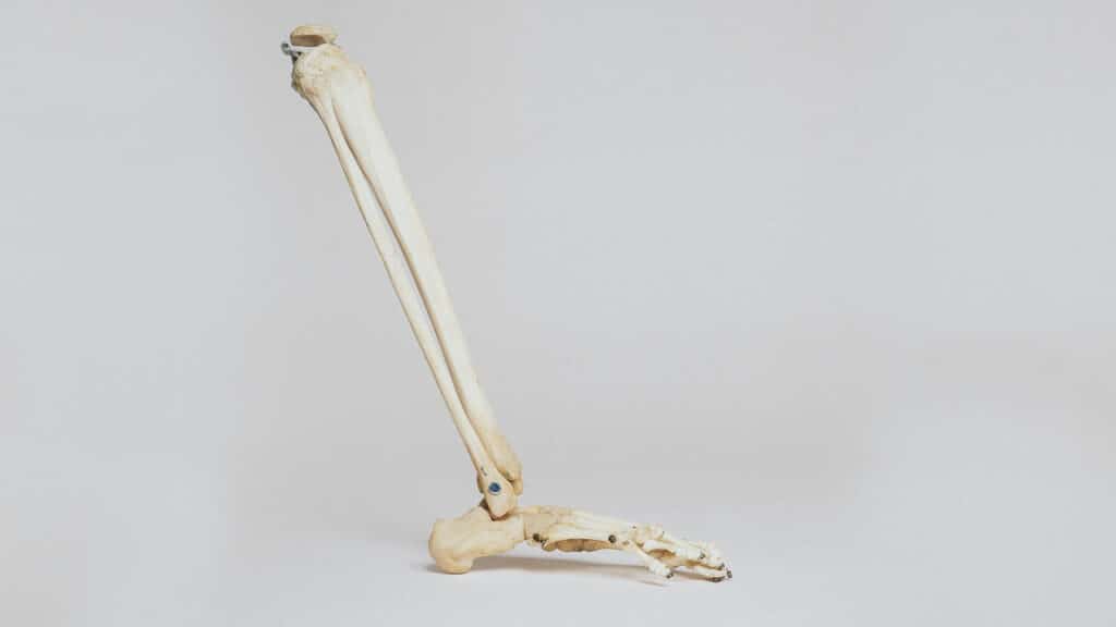 The Proper Way To Showcase Metal Rod Fibula Complications