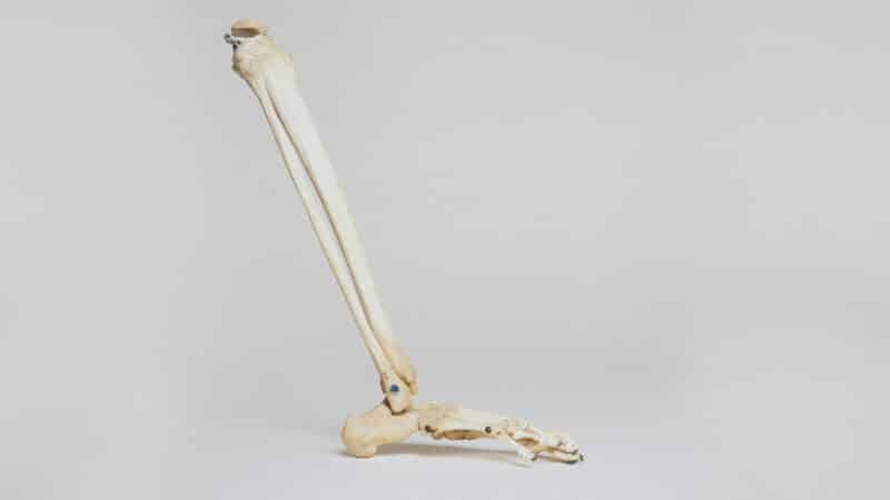 The Proper Way To Showcase Metal Rod Fibula Complications