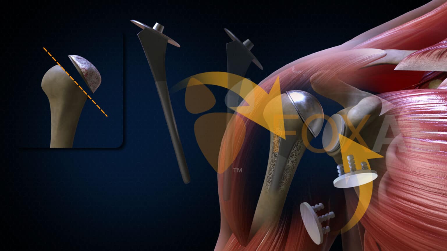 Shoulder Replacement Surgery | Fox Animated Engineering