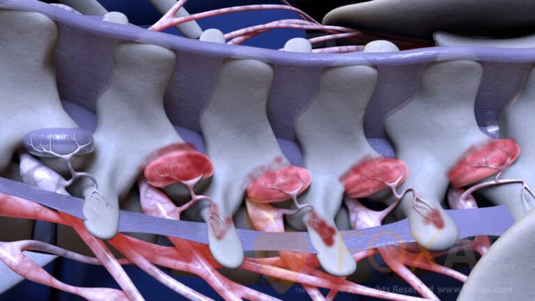 Highlighting The Risks Of Rhizotomy Using Legal Animation