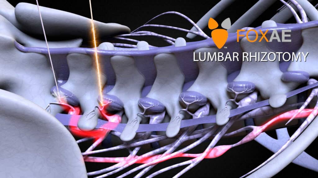 Highlighting The Risks Of Rhizotomy Using Legal Animation