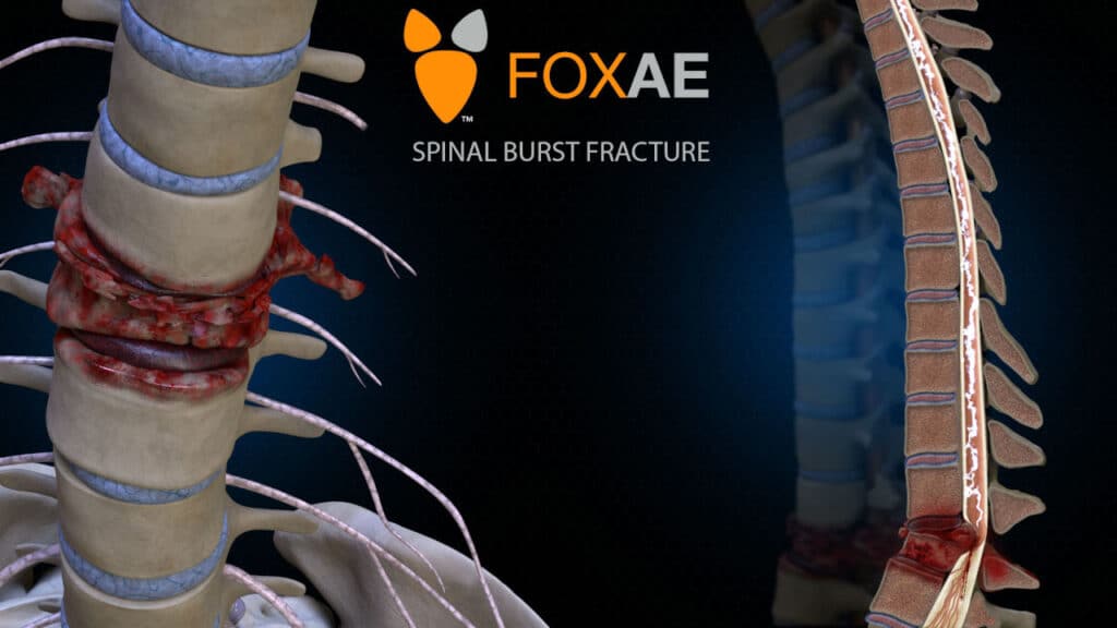 Burst Fracture: Enhance Damages Award With Legal Animation