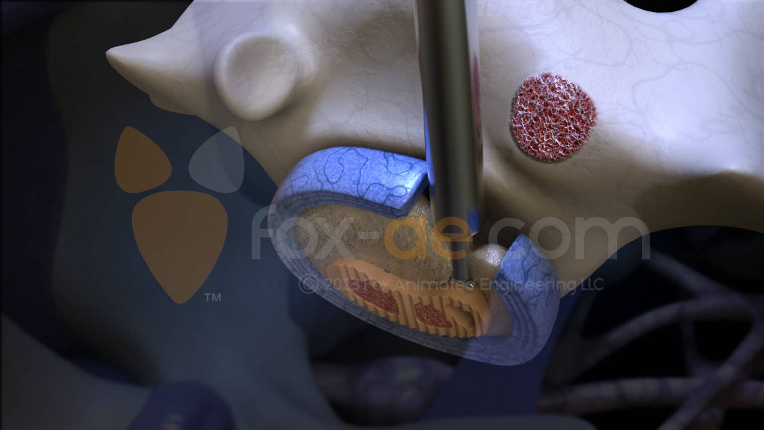 Illustrating Foraminotomy Procedure In The Courtroom