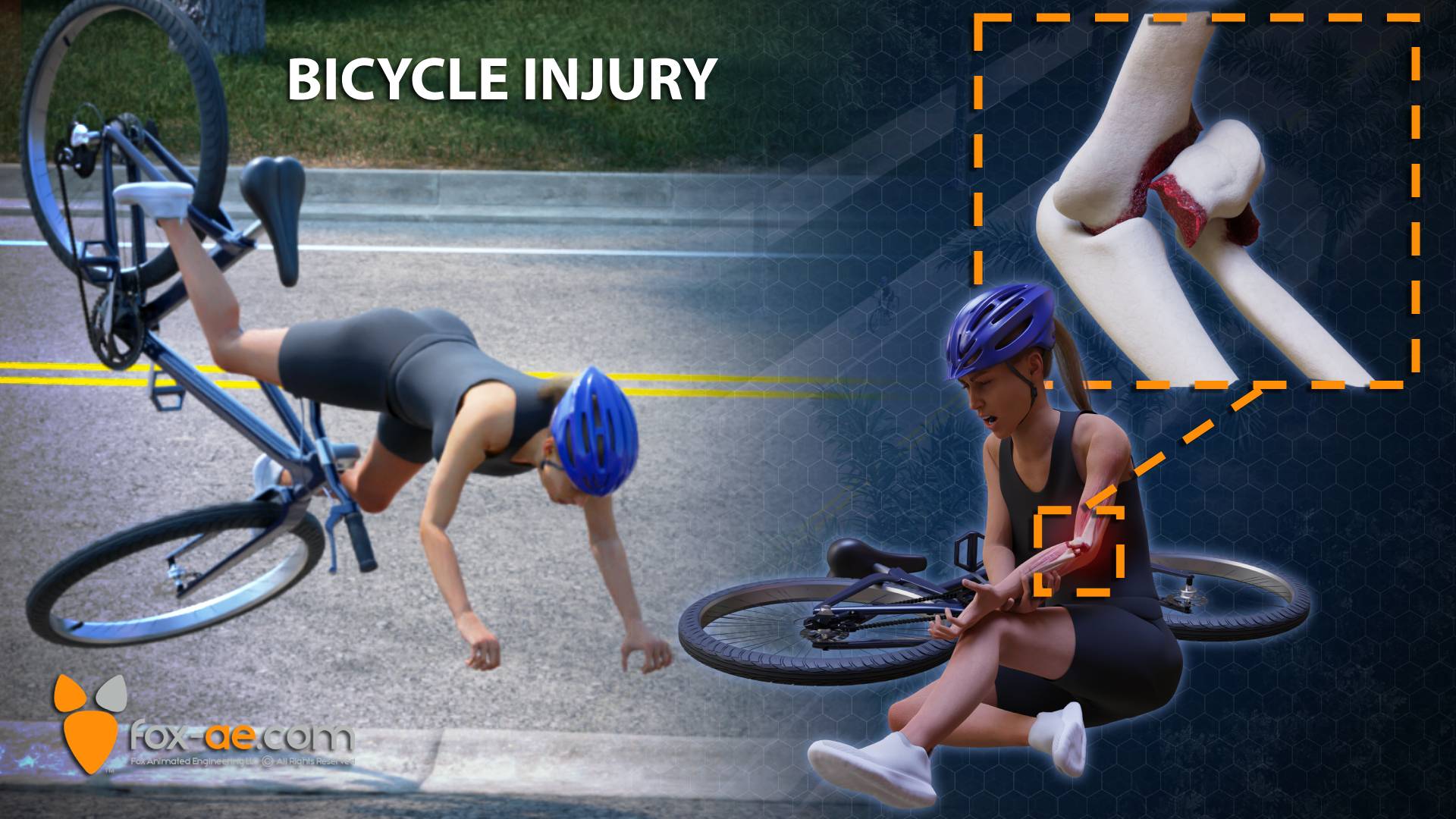 Incorrect Construction Causes Massive Fracture to Bicyclist