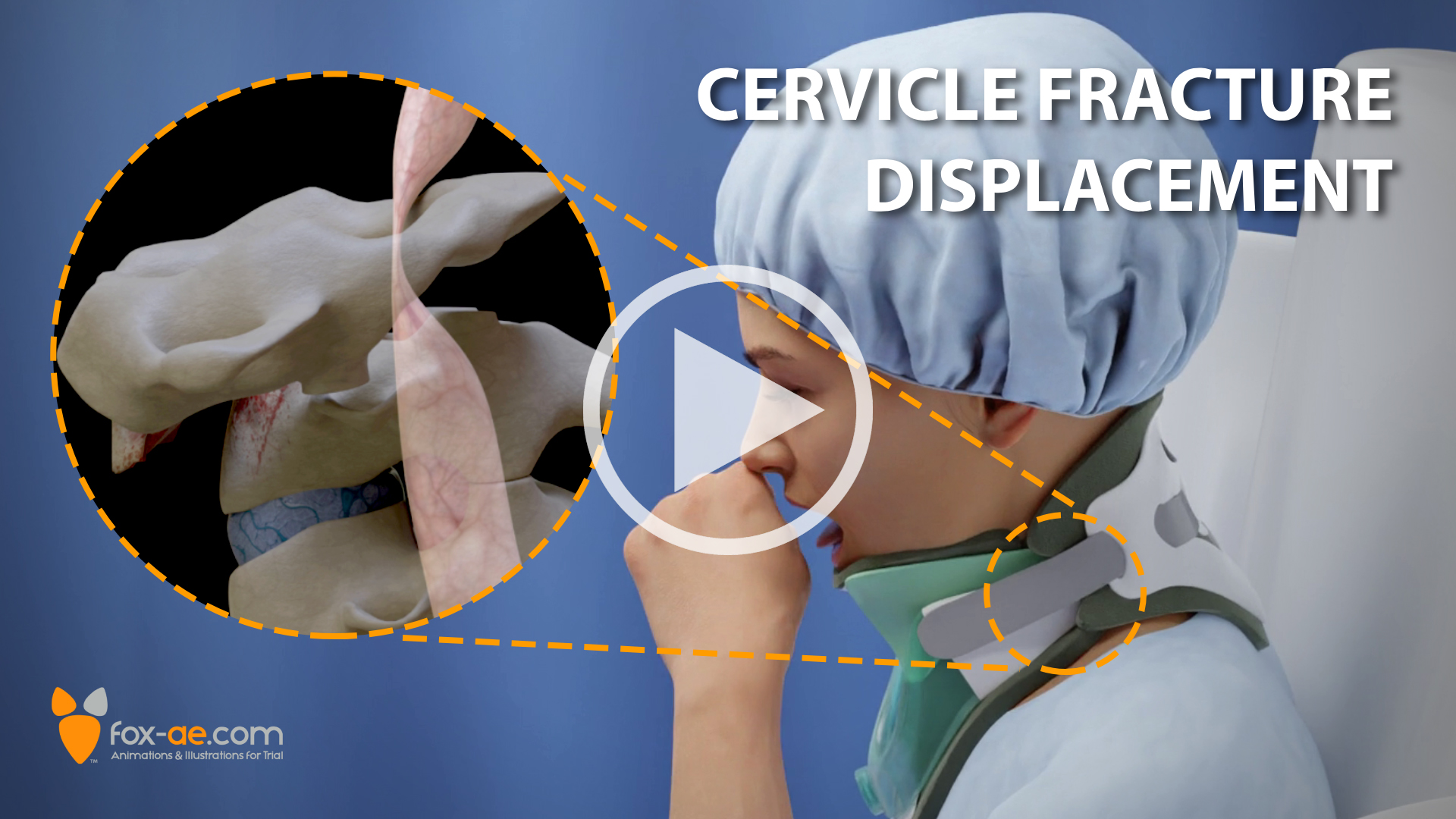 Cervical Fracture Compresses Spinal Cord | Fox Animated Engineering