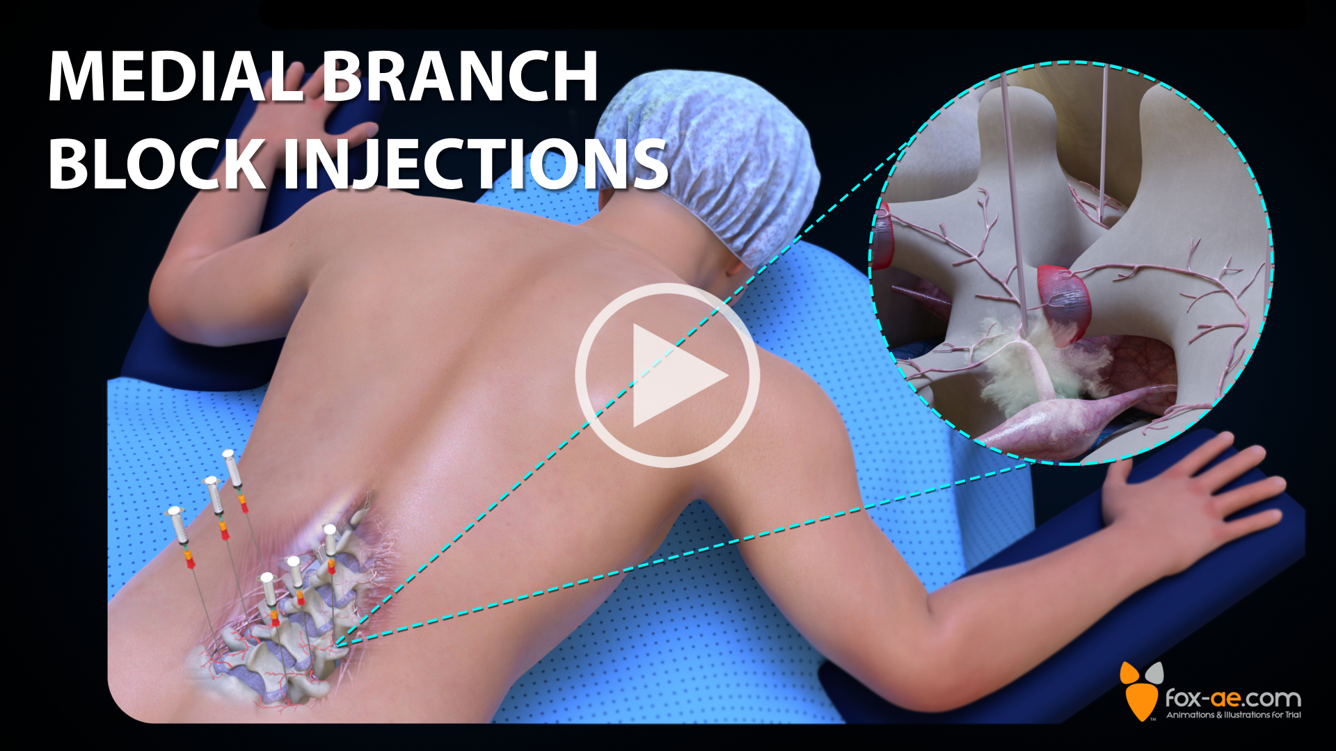 Medial Branch Block Injections | Fox Animated Engineering