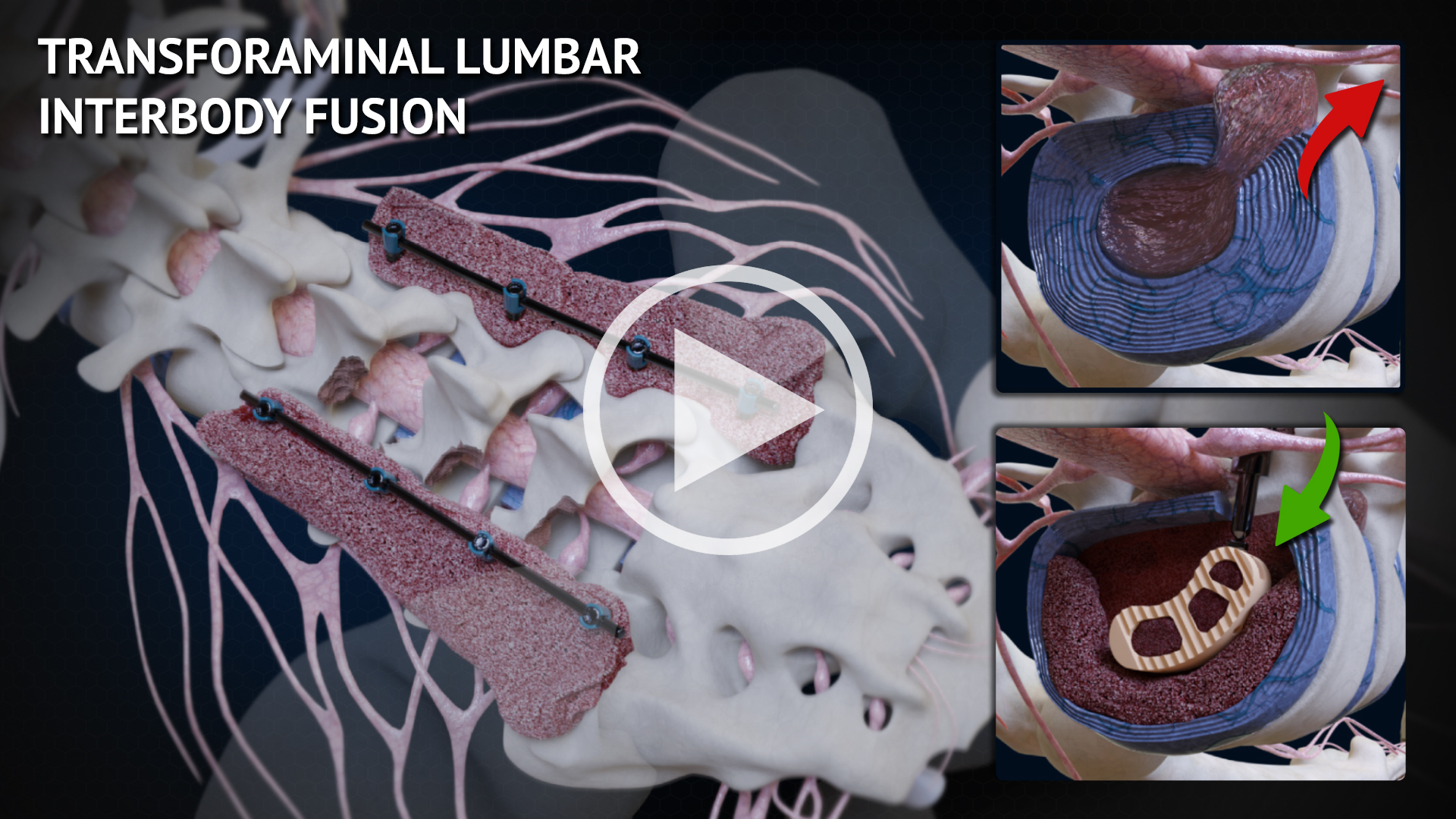 Transforaminal Lumbar Interbody Fusion (TLIF) L3-S1 | Fox Animated ...