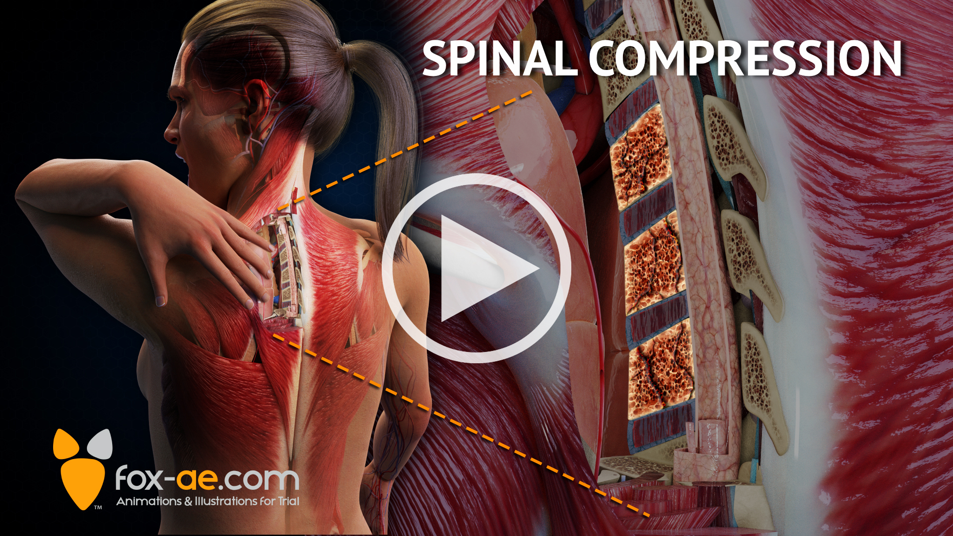Spinal Compression Fracture | Fox Animated Engineering