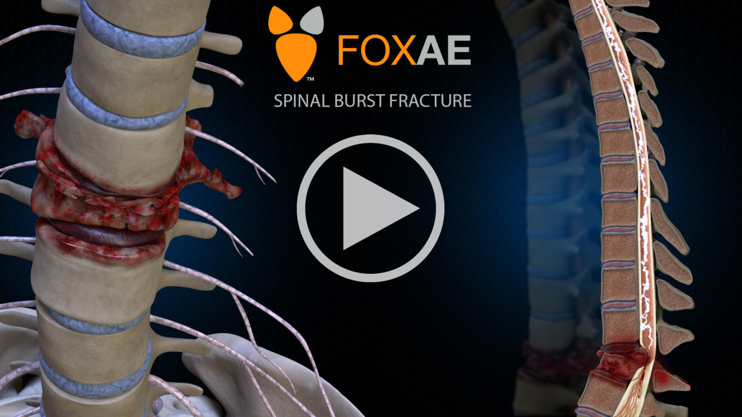 Spinal Burst Fracture | Fox Animated Engineering