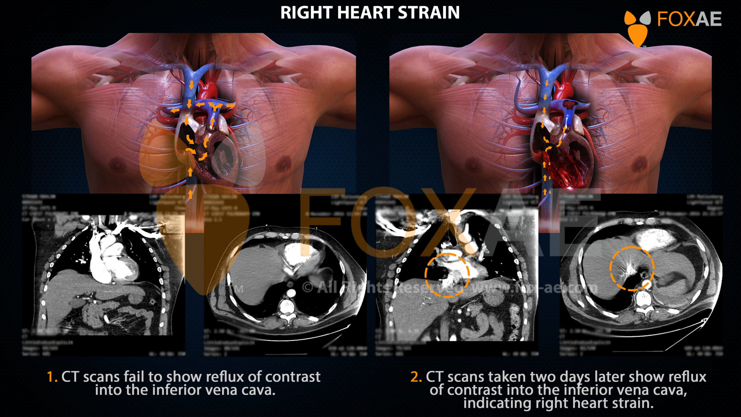 Right Heart Strain Fox Animated Engineering Right Heart Strain Fox Animated Engineering