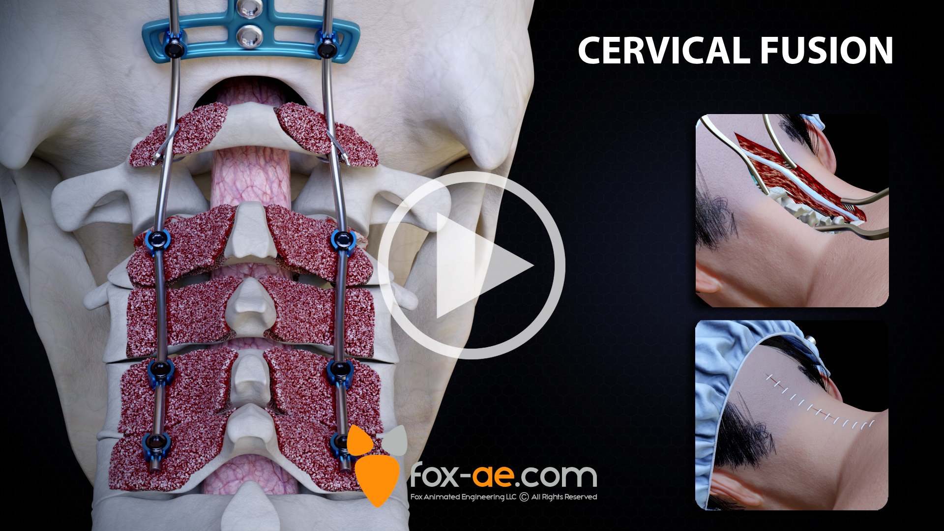 Posterior Cervical Fusion | Fox Animated Engineering
