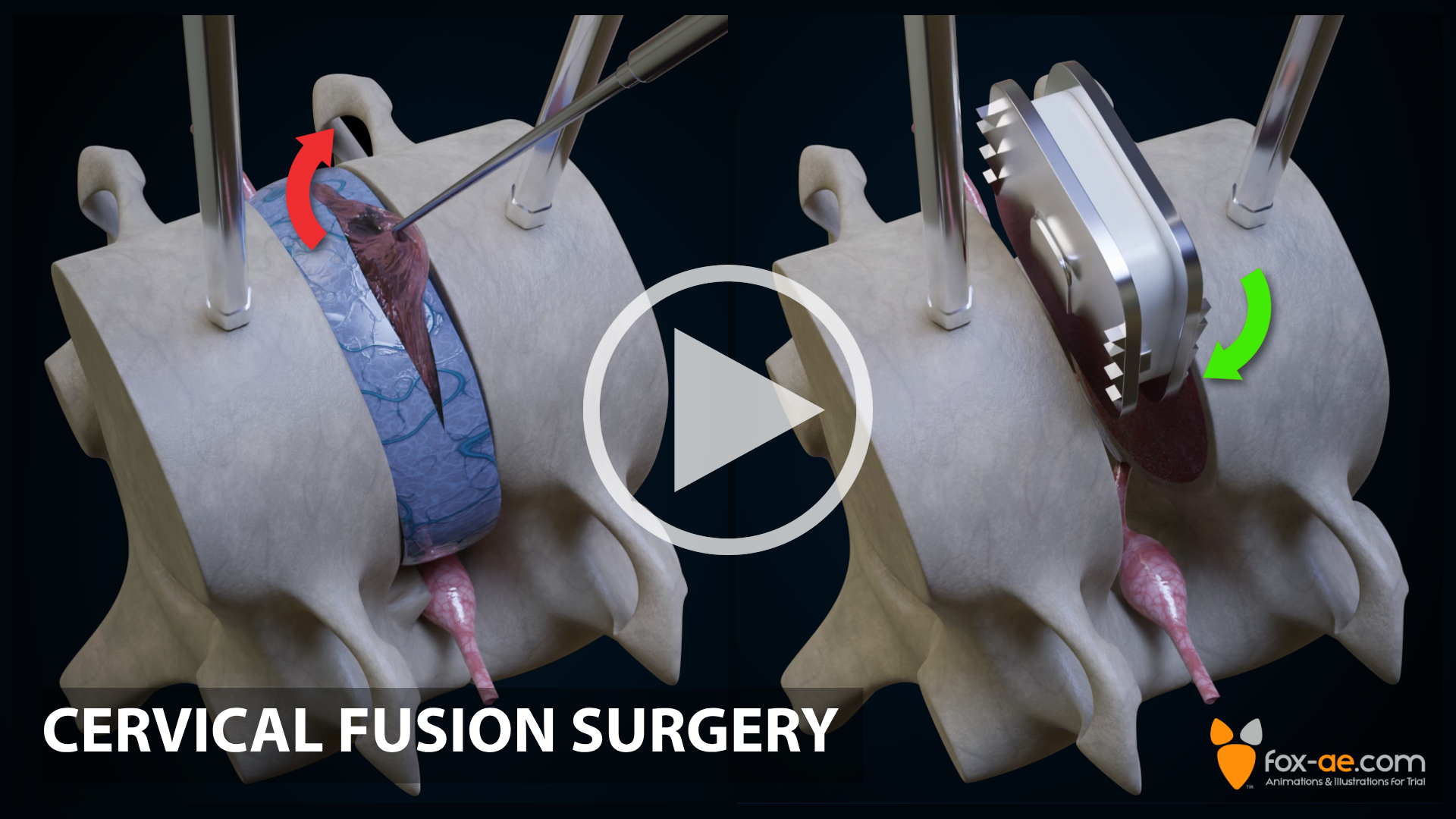 Anterior Cervical Fusion | Fox Animated Engineering