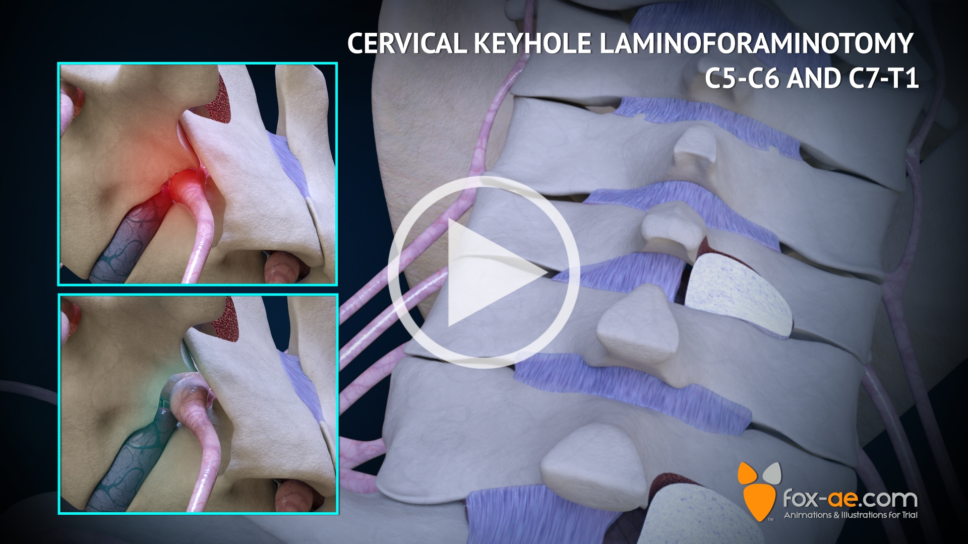 Cervical Keyhole Laminoforaminotomy | Fox Animated Engineering