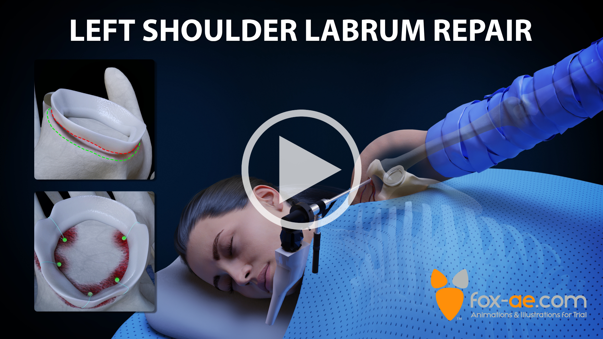 Left Shoulder Labrum Repair | Fox Animated Engineering