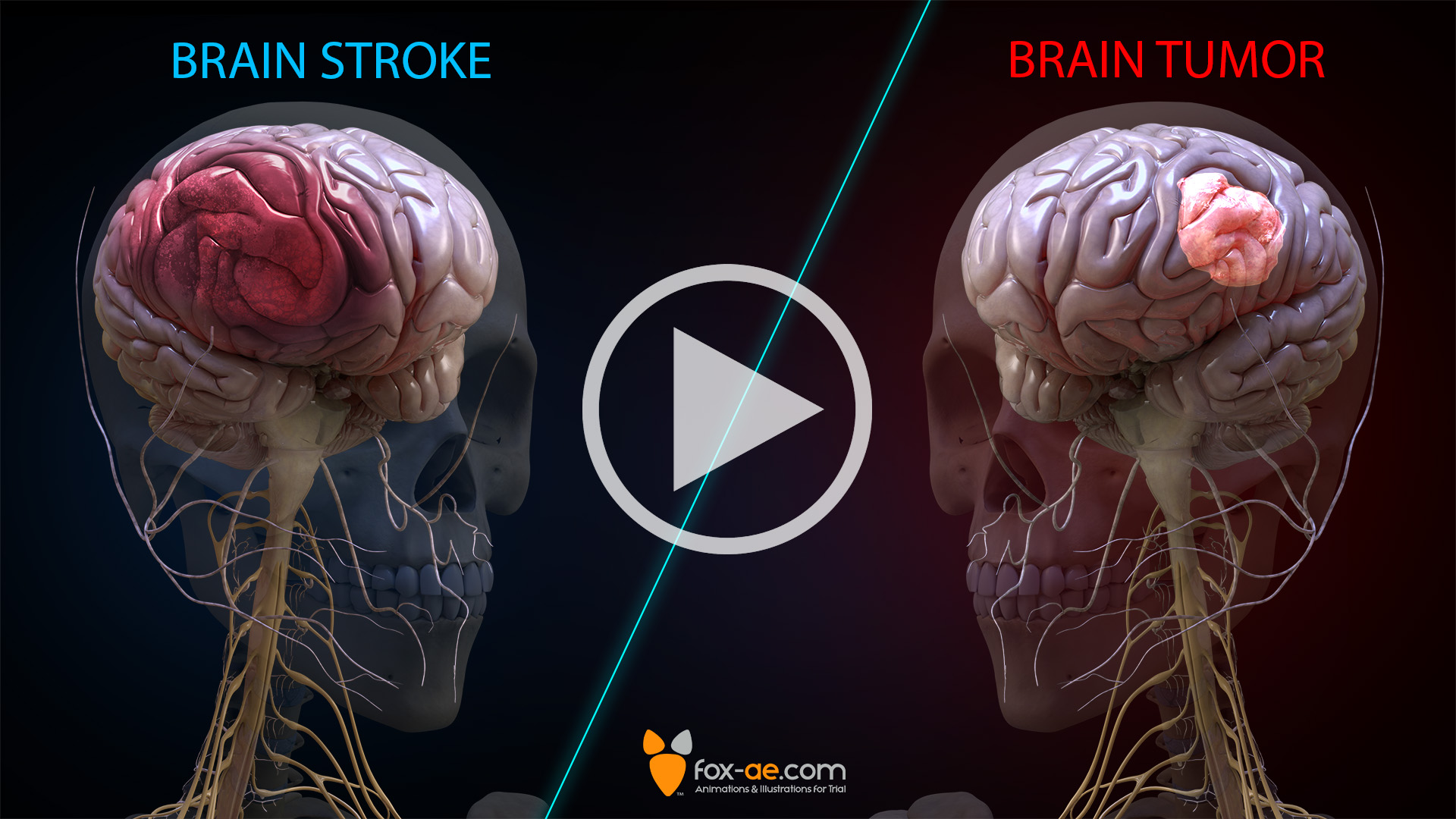 Missed Brain Tumor Diagnosis | Fox Animated Engineering