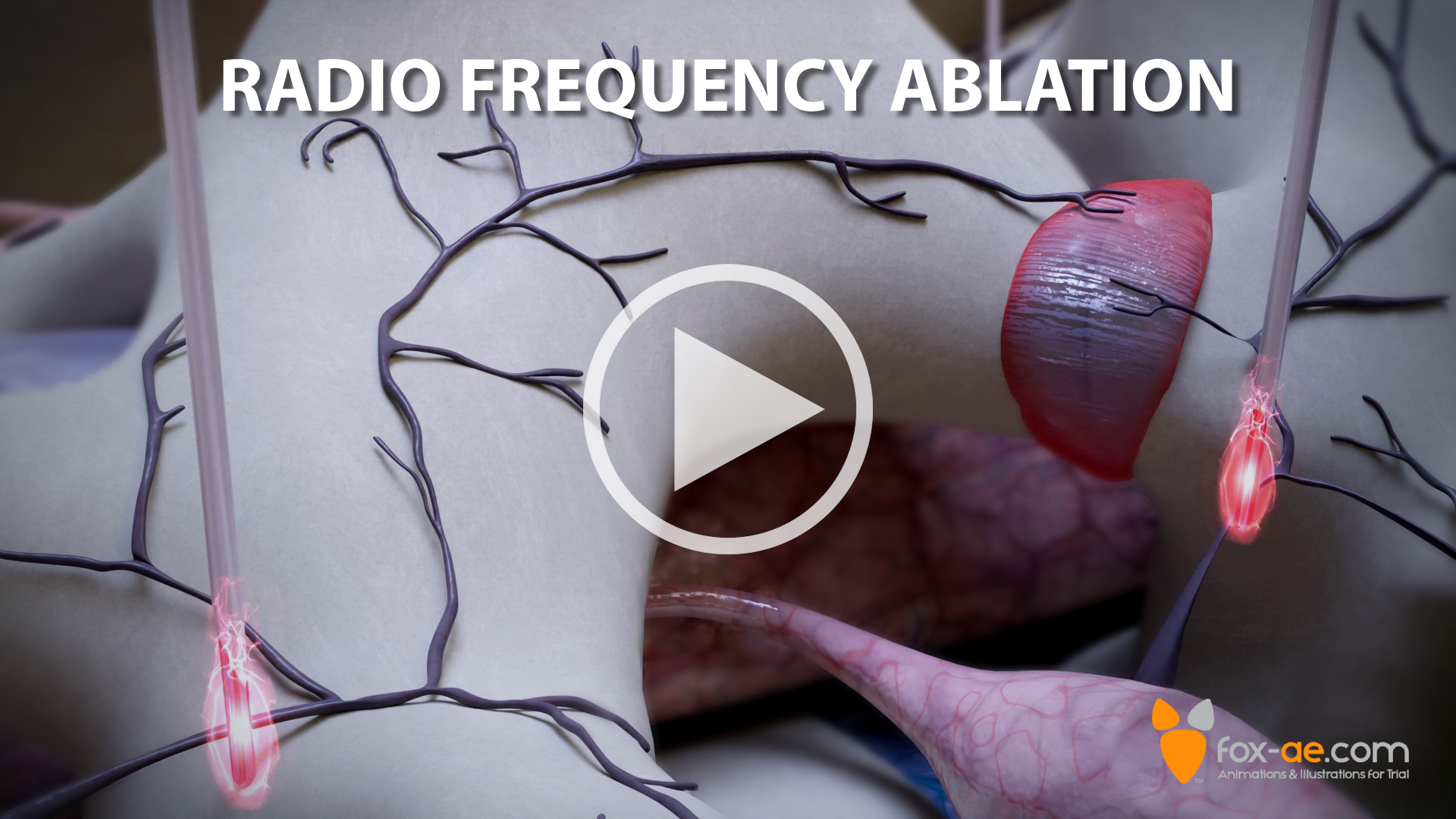 Radio Frequency Ablation | Fox Animated Engineering